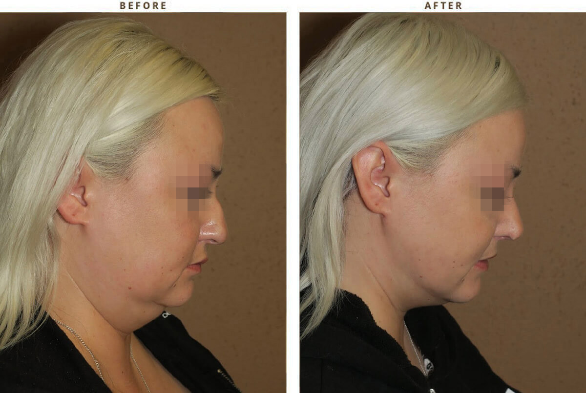 Liposuction of the neck – Before and After Pictures * | Dr Turowski ...